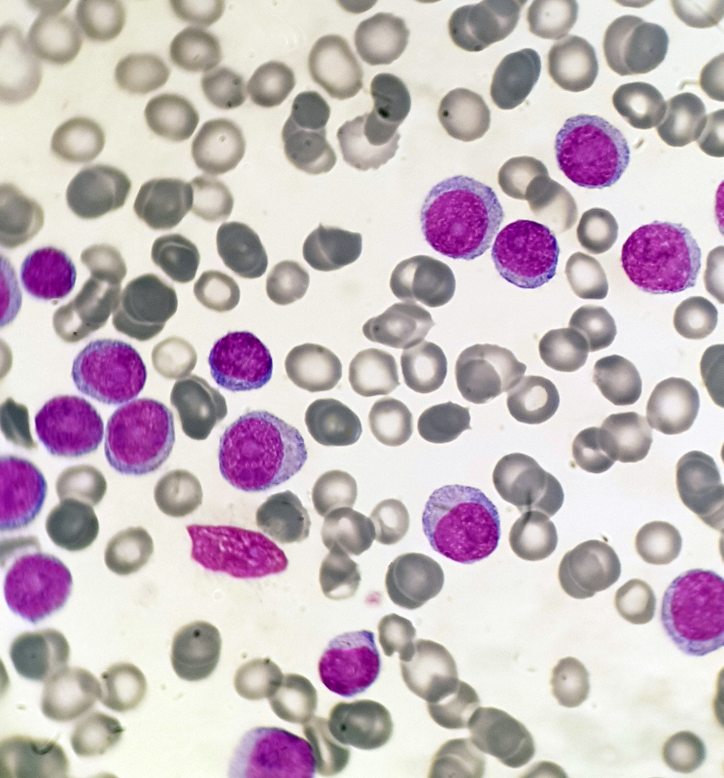 Το περιφερικό επίχρισμα ή «πλακάκι» – Χριστοφορίδου Άννα – Αιματολόγος